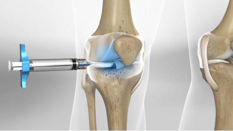 Revitalize Your Knee Health with Hyaluronic Acid Injection: A Comprehensive Guide - PainTherapyCare