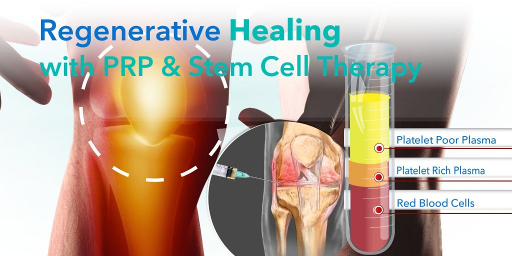 Platelet-Rich Plasma (PRP) Therapy, PRP Therapy Near Me In Brooklyn NYC ...